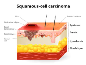 How To Get Life Insurance After Skin Cancer in 2025 - PinnacleQuote